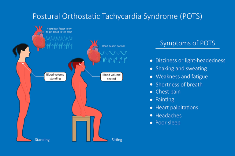 Postural Orthostatic Tachycardia Syndrome (POTS) – United Physical ...